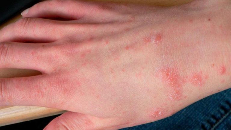 17 Common Skin Rashes in Children - DailyHealthTips
